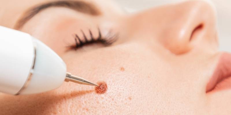 Skin Tag Removal - Day Spa New Jersey | Refined Skin Club