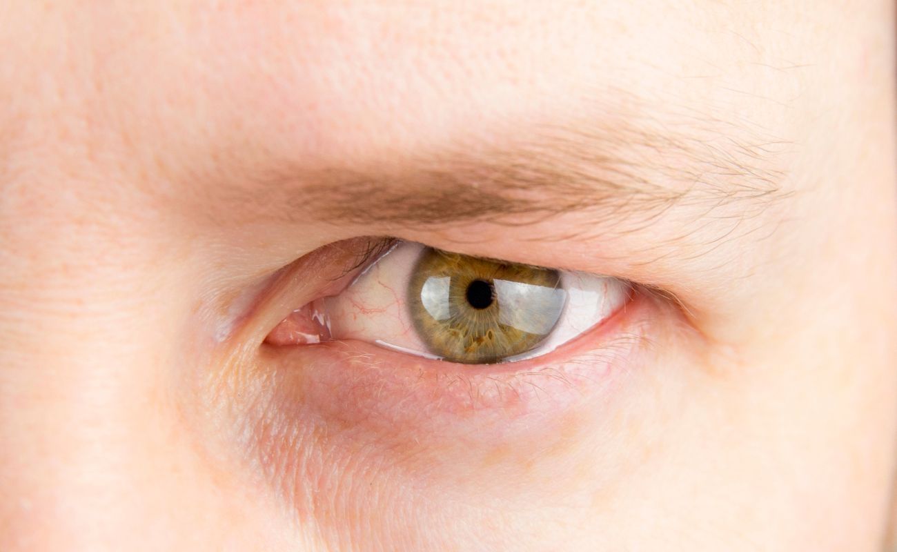 What's Causing Droopy Eyes And How To Treat Them